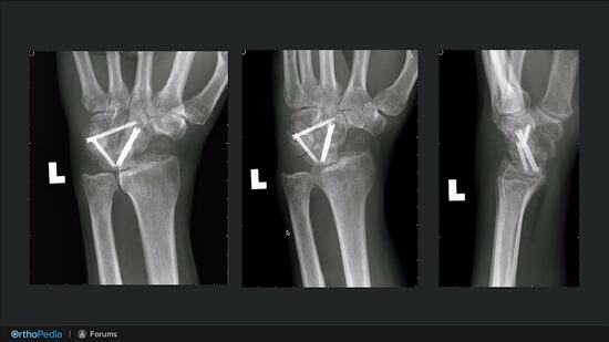 Hand, Wrist, and Elbow OTIF: Scaphoid Nonunion Advanced Collapse—SNAC ...
