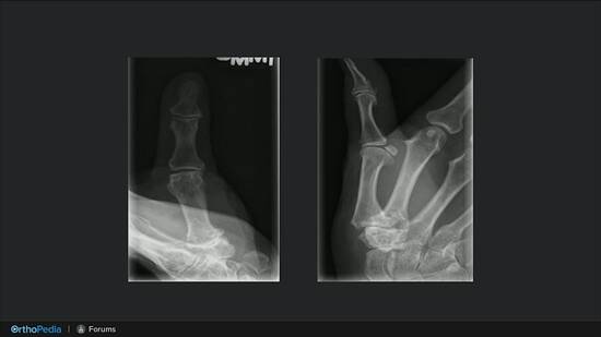 Panel Discussion on Carpometacarpal (CMC) Arthritis and Thumb ...