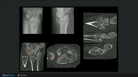 Innovations in Hand and Wrist Surgery: Part 6—Distal Radius Fractures ...