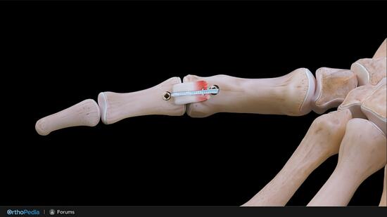 Panel Discussion on the Mini Comprehensive Fixation System (CFS) and ...