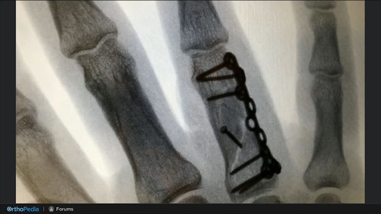 Innovations in the Management of Hand and Upper Extremity Fractures—The ...