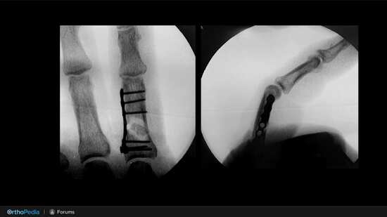 Innovations in the Management of Hand and Upper Extremity Fractures—The ...