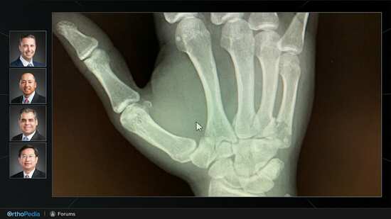 Innovations in the Management of Hand and Upper Extremity Fractures—The ...