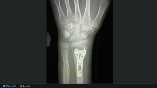 Nano Arthroscopy and Minimally Invasive Hand, Wrist, and Elbow ...