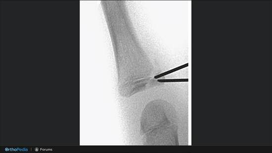 NanoScope™ Operative Arthroscopy System and Minimally Invasive Hand ...