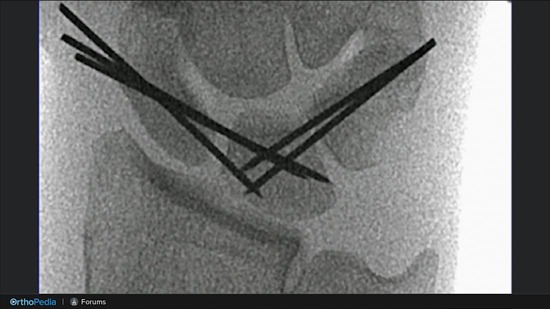 NanoScope™ Operative Arthroscopy System and Minimally Invasive Hand ...