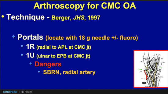 Arthroscopy in Thumb Carpometacarpal (CMC) Arthritis : OrthoPedia