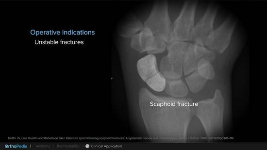 Scaphoid Fracture: General Surgical Considerations : OrthoPedia
