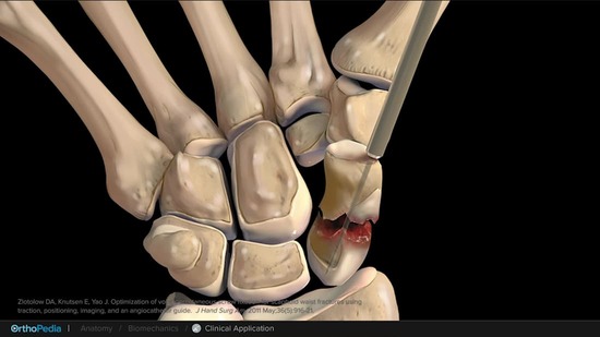 Scaphoid Fracture: Percutaneous Reduction and Fixation : OrthoPedia