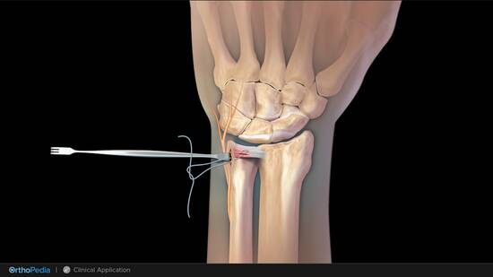 Triangular Fibrocartilage Complex Injury: Inside-to-Outside Repair ...
