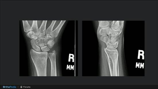 Case Discussion on Open Foveal Tunnel Repair of a Palmer Type 1B Tear ...
