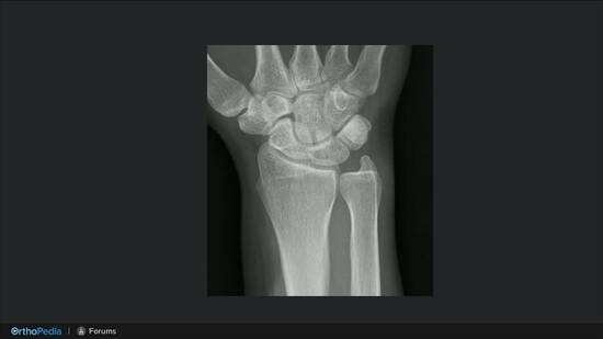 Ulnar-Side Wrist Pain: The TFCC and Ulnocarpal Abutment—Part 3: Use of ...