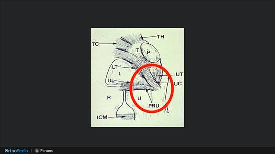 Overview of Ulnar-Sided Wrist Pain : OrthoPedia