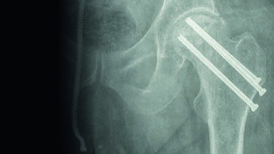 Femoral Neck Fractures: Literature Review on Posterior-Superior Screw ...