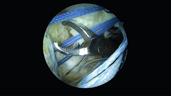 Femoroacetabular Impingement: Circumferential Acetabular Labral ...