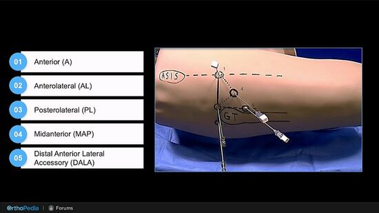 Fundamentals in Hip Preservation Surgery: Hip Arthroscopy Access and ...