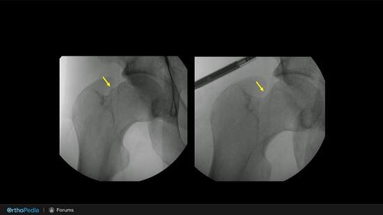 Fundamentals in Hip Preservation Surgery: Radiographic Assessment of ...