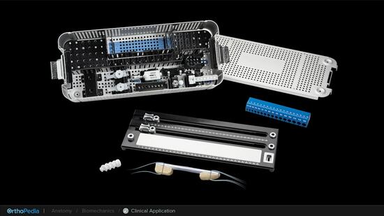 ACL Injuries: Arthroscopic-Assisted ACL Reconstruction BTB Graft Using the BTB TightRope ...