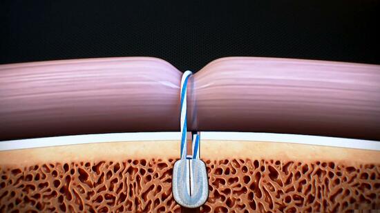 ACL Injuries: Literature Review on Iliotibial Band Tenodesis for ...