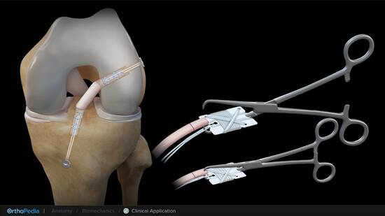 ACL Injuries: Quadriceps Tendon Graft Preparation : OrthoPedia