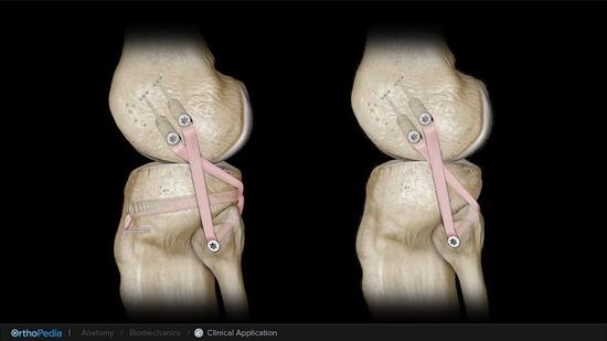 Collateral Ligament Injuries: General Surgical Considerations for ...