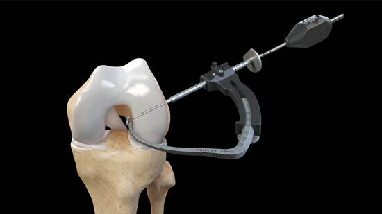 Dr. Baraga Demonstrates Tips and Pearls for ACL Tears: Ensure the ...