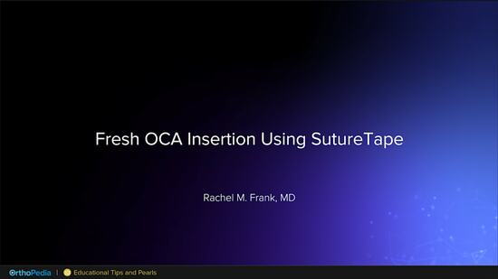 Dr. Frank Demonstrates Tips and Pearls for Osteochondral Defects: Using ...