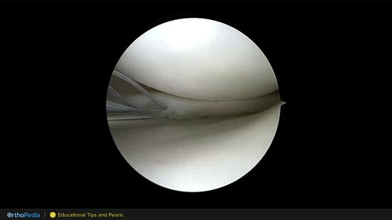 Dr. Krych Demonstrates Tips and Pearls for Meniscal Pathologies ...
