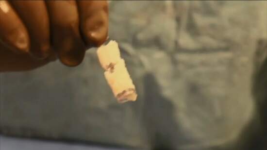 Dr. Lavender Demonstrates Tips and Pearls for ACL Tears: Collecting ...