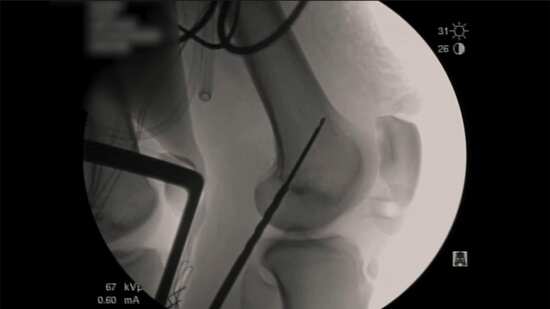 Dr. Pace Demonstrates Tips and Pearls for ACL Tears: How to Avoid ...
