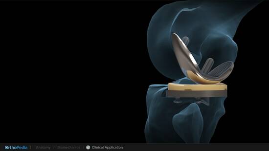 Knee Arthritis: Partial Knee Arthroplasty Using the iBalance® UKA ...