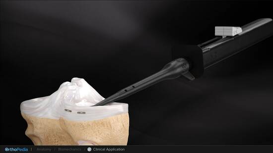 Knee Meniscal Pathology: All-Inside Meniscus Repair Using the Meniscal ...