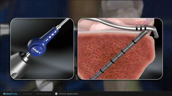 Knee Meniscal Pathology: Lateral Meniscal Transplant Using the Double ...