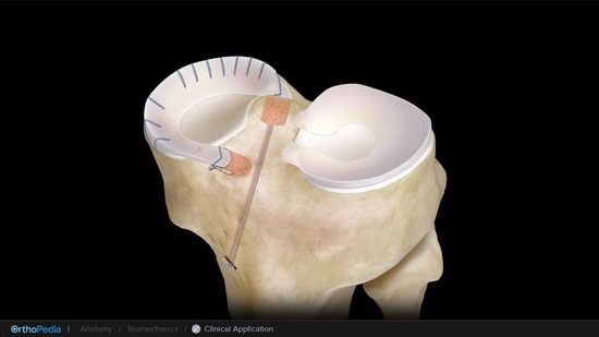 Medial Meniscus Transplant: Double Bone Plug Technique : OrthoPedia