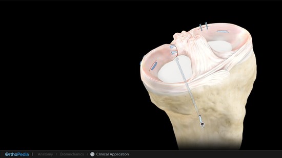 Meniscal Pathology: General Surgical Considerations : OrthoPedia
