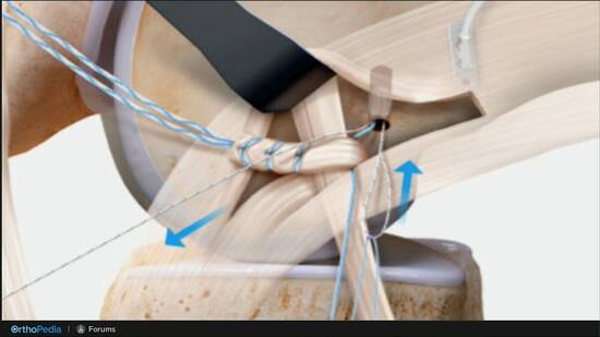 Lateral Extra-Articular Tenodesis for Anterolateral Instability of the ...