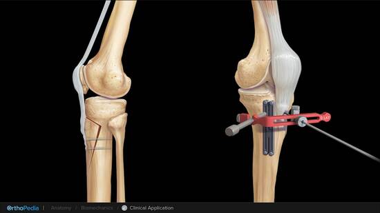 Patellofemoral Joint Pathology: Patellofemoral Joint Malalignment ...
