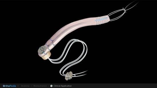 PCL Injuries: Arthroscopic Inlay PCL Reconstruction With a SpeedWhip ...