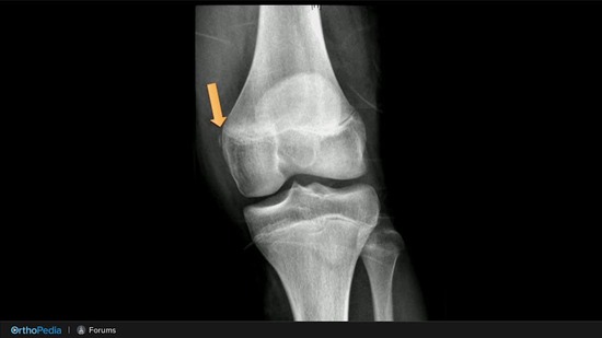Sports Medicine Fellowship Forum: MCL Primary Repair and the ...