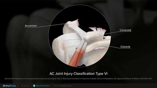Biomechanics of the Shoulder With Acromioclavicular Joint Injuries ...