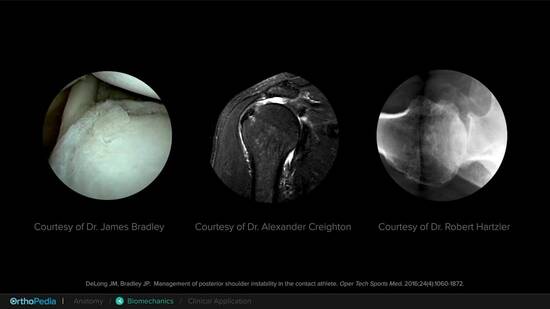Biomechanics of the Shoulder With Posterior Glenohumeral Joint ...