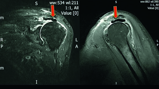 Complex and Revision Rotator Cuff Course: Dermal Allograft Techniques ...