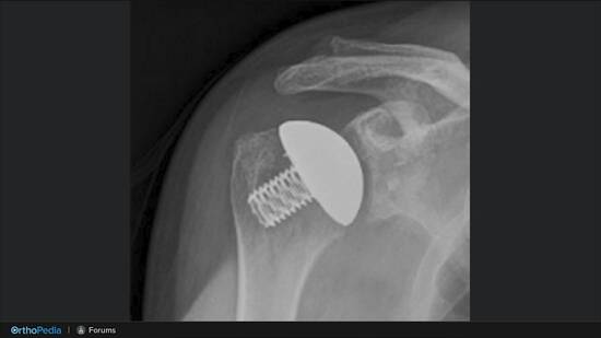 Complex and Revision Shoulder Arthroplasty: Complex Humeral Scenarios ...