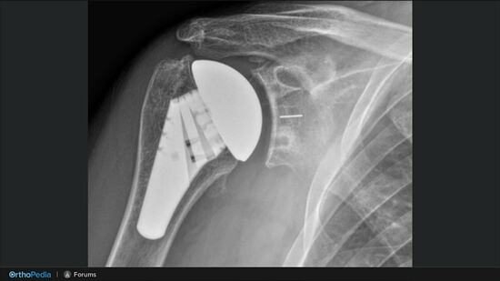 Complex and Revision Shoulder Arthroplasty: Managing Atypical Glenoids in Anatomic Total ...