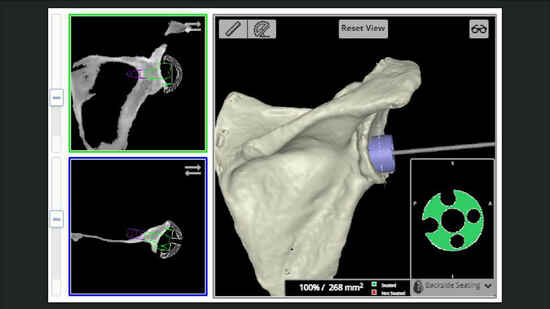 Complex and Revision Total Shoulder Arthroplasty: Cadaveric ...