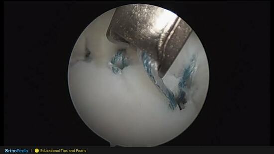 Dr. Paci Demonstrates Tips and Pearls for Glenohumeral Joint ...