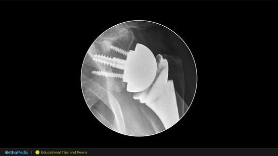 Dr. Romeo Demonstrates Tips and Pearls for Glenohumeral Joint Arthritis ...