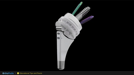 Dr. Werner Demonstrates Tips and Pearls for Glenohumeral Arthritis ...