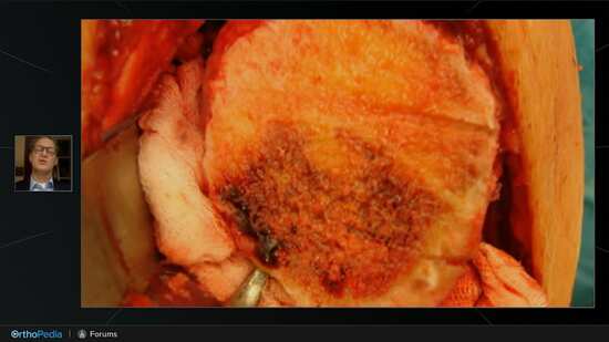 Eclipse™ Total Shoulder Arthroplasty System: Part 2 – The European ...