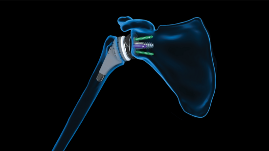 Glenohumeral Joint Arthritis: Literature Review on Lateralization in ...